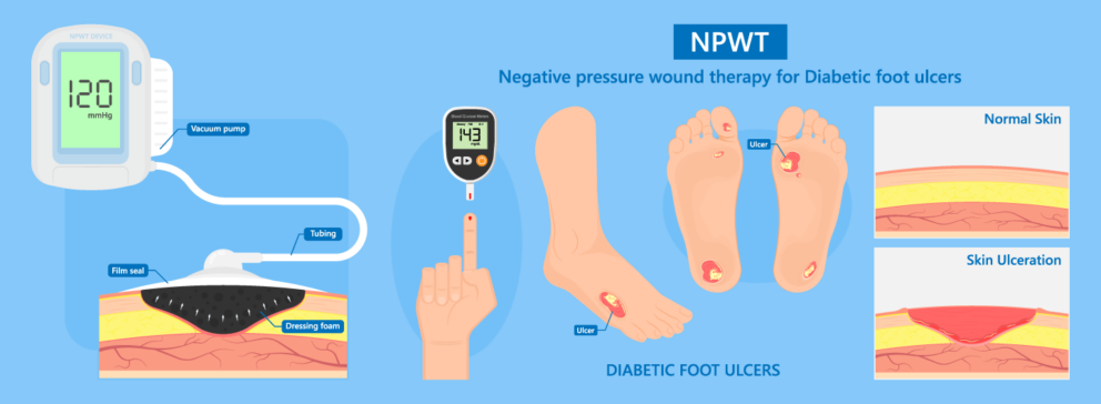 Negative Pressure Wound Therapy Explained.