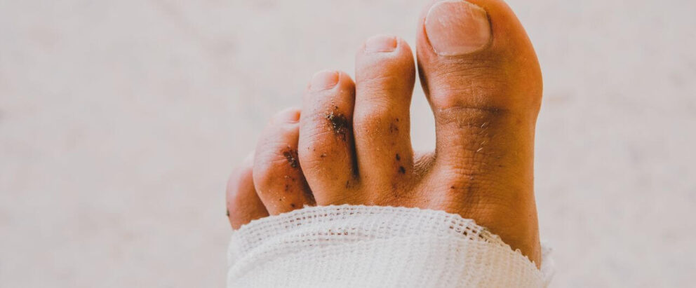 Understanding Pyoderma Gangrenosum | Advanced Wound Care